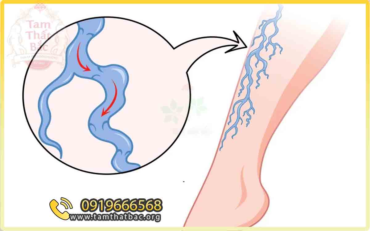 Suy giãn tĩnh mạch chi dưới: Nguyên nhân, dấu hiệu, cách điều trị